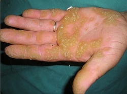 Rare Skin Diseases It's Really Hard Right Now': Calgary Couple